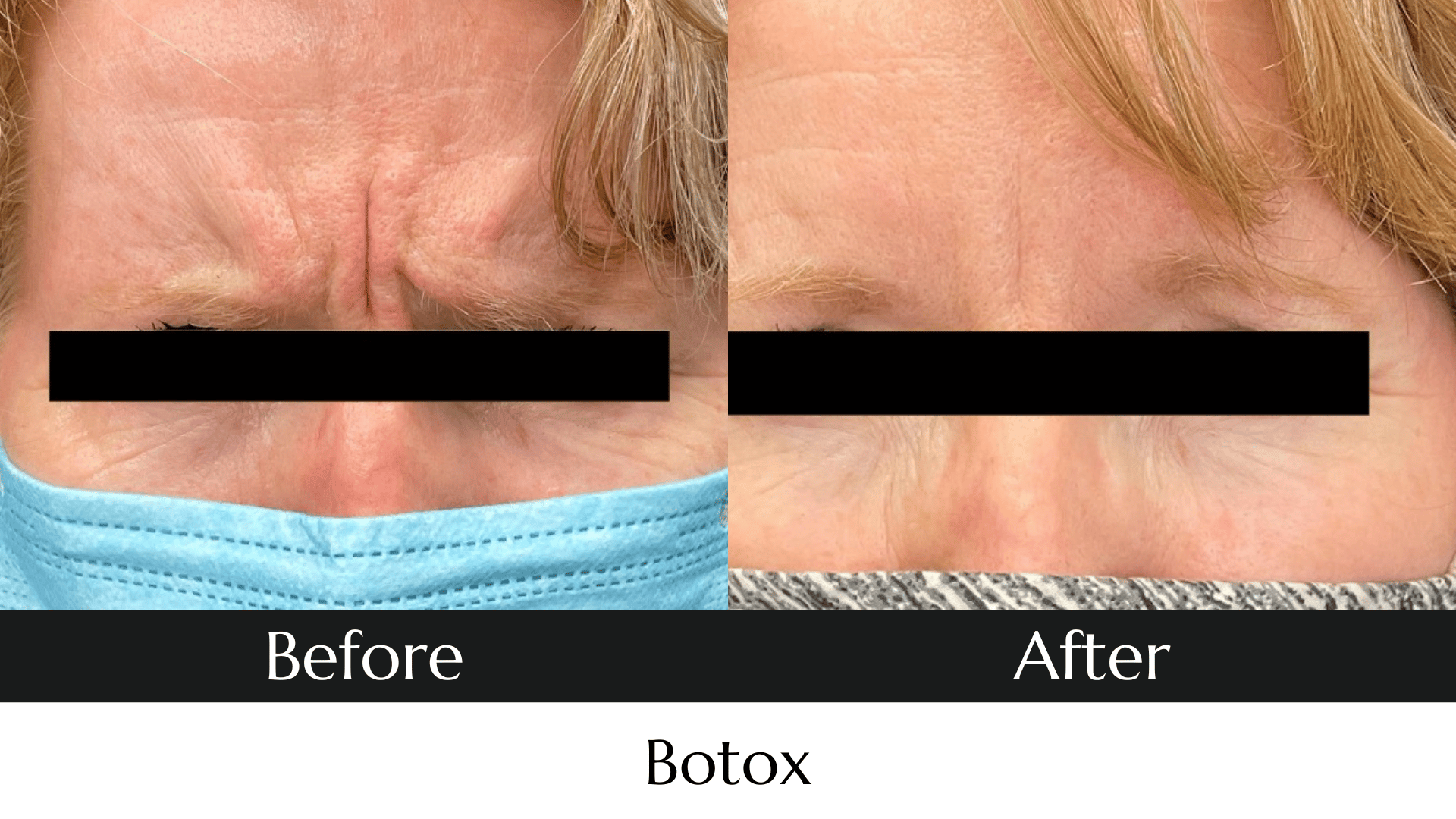 BOTOX® Therapeutic