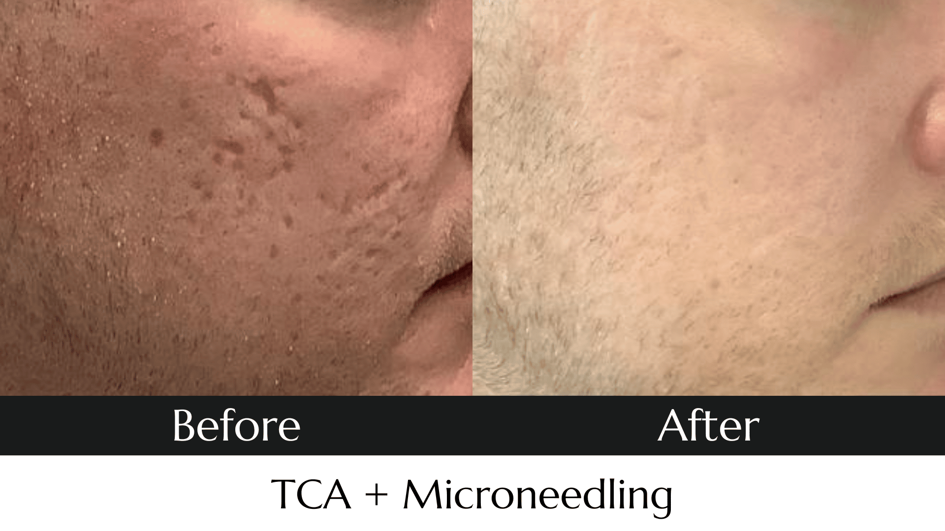 Microneedling - MedAesthetics