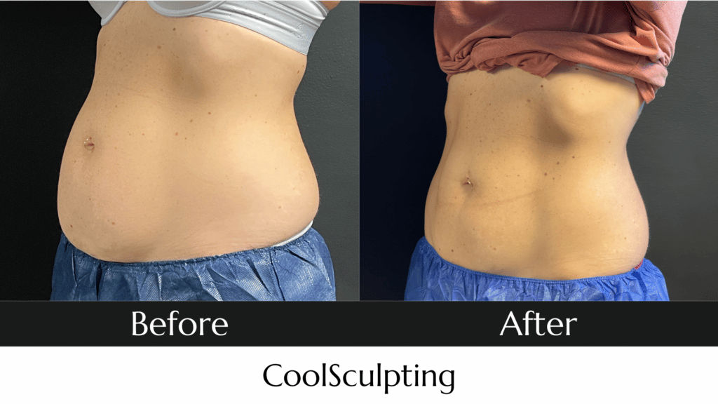 CoolSculpting