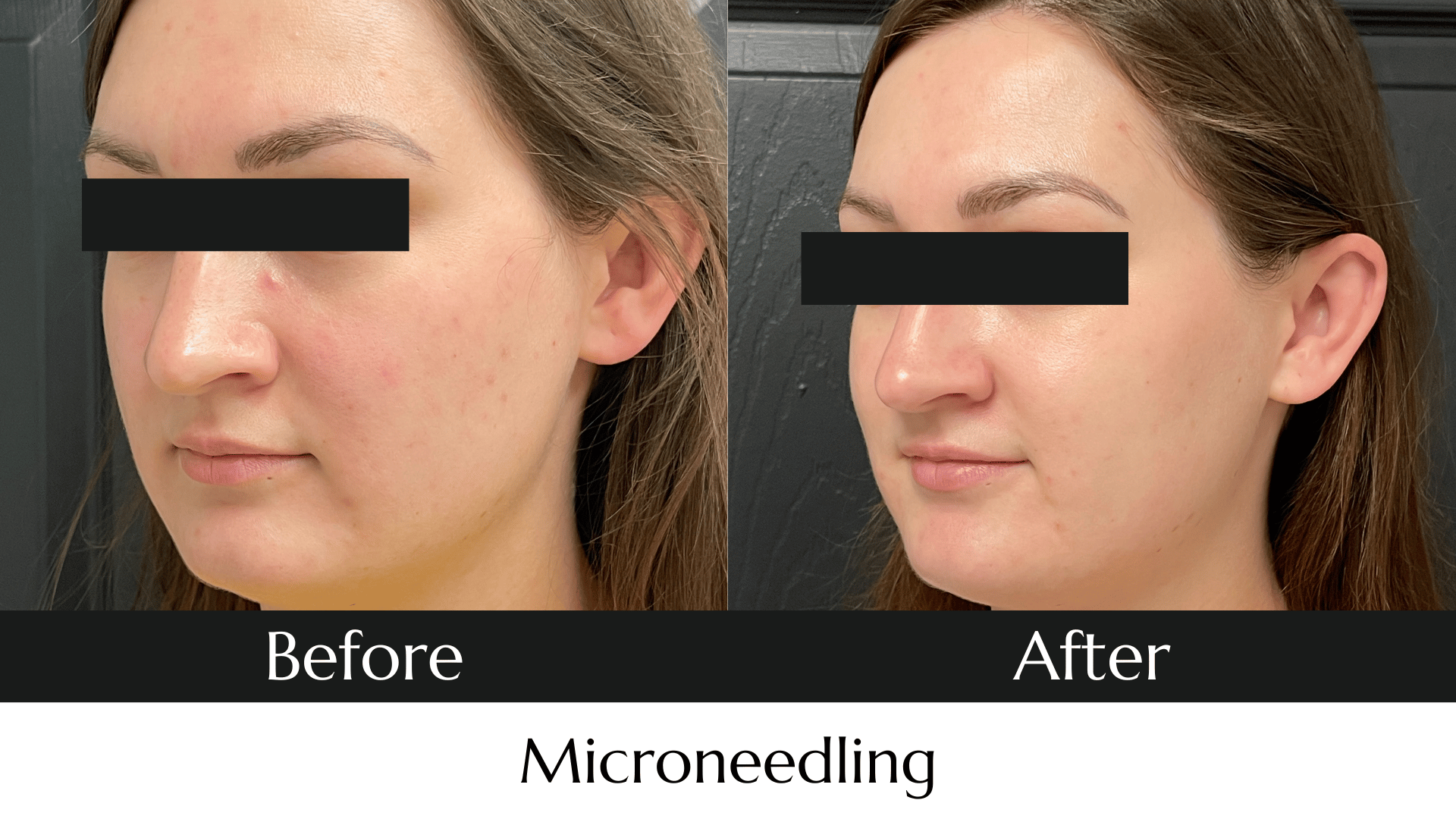 Microneedling - MedAesthetics