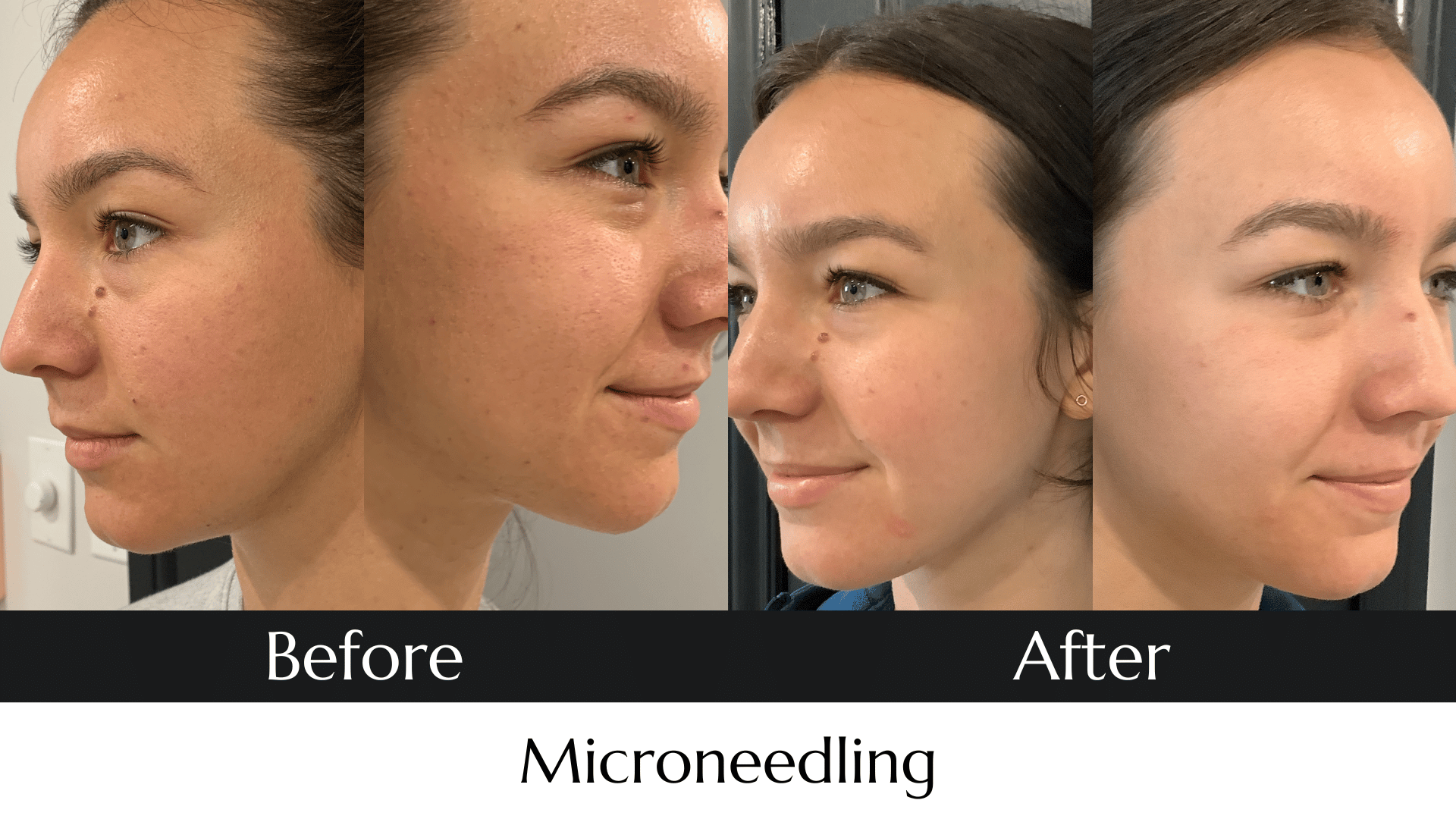 Microneedling - MedAesthetics