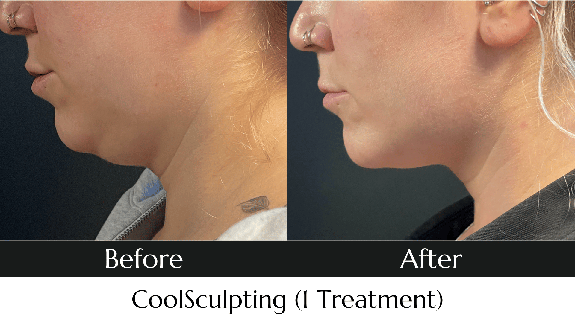 CoolSculpting