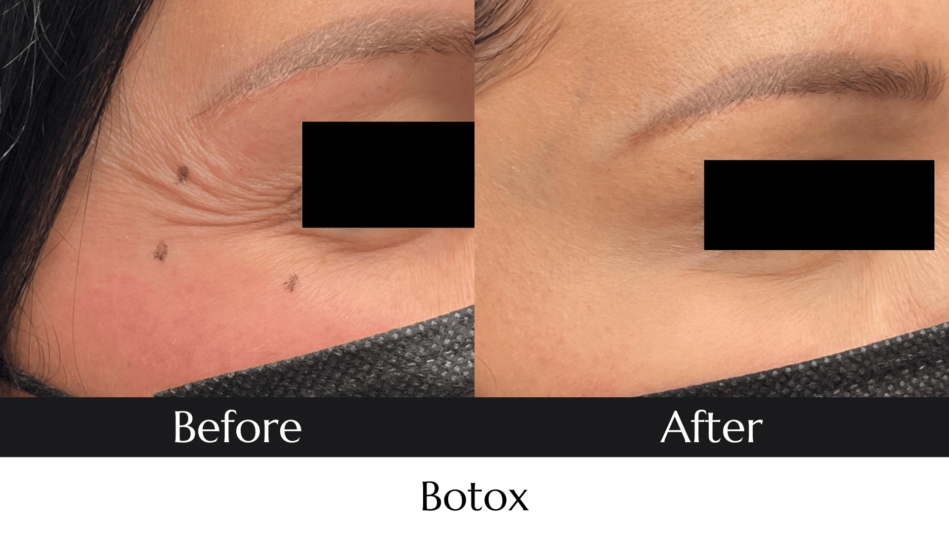 BOTOX® Cosmetic