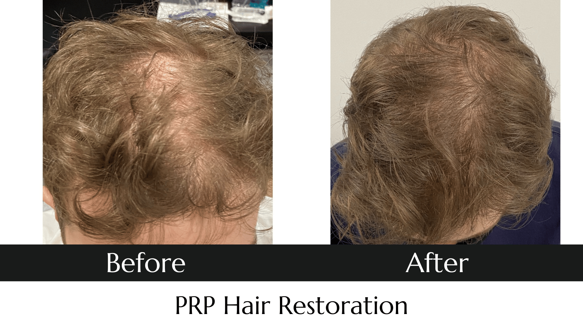 PRP Hair Restoration