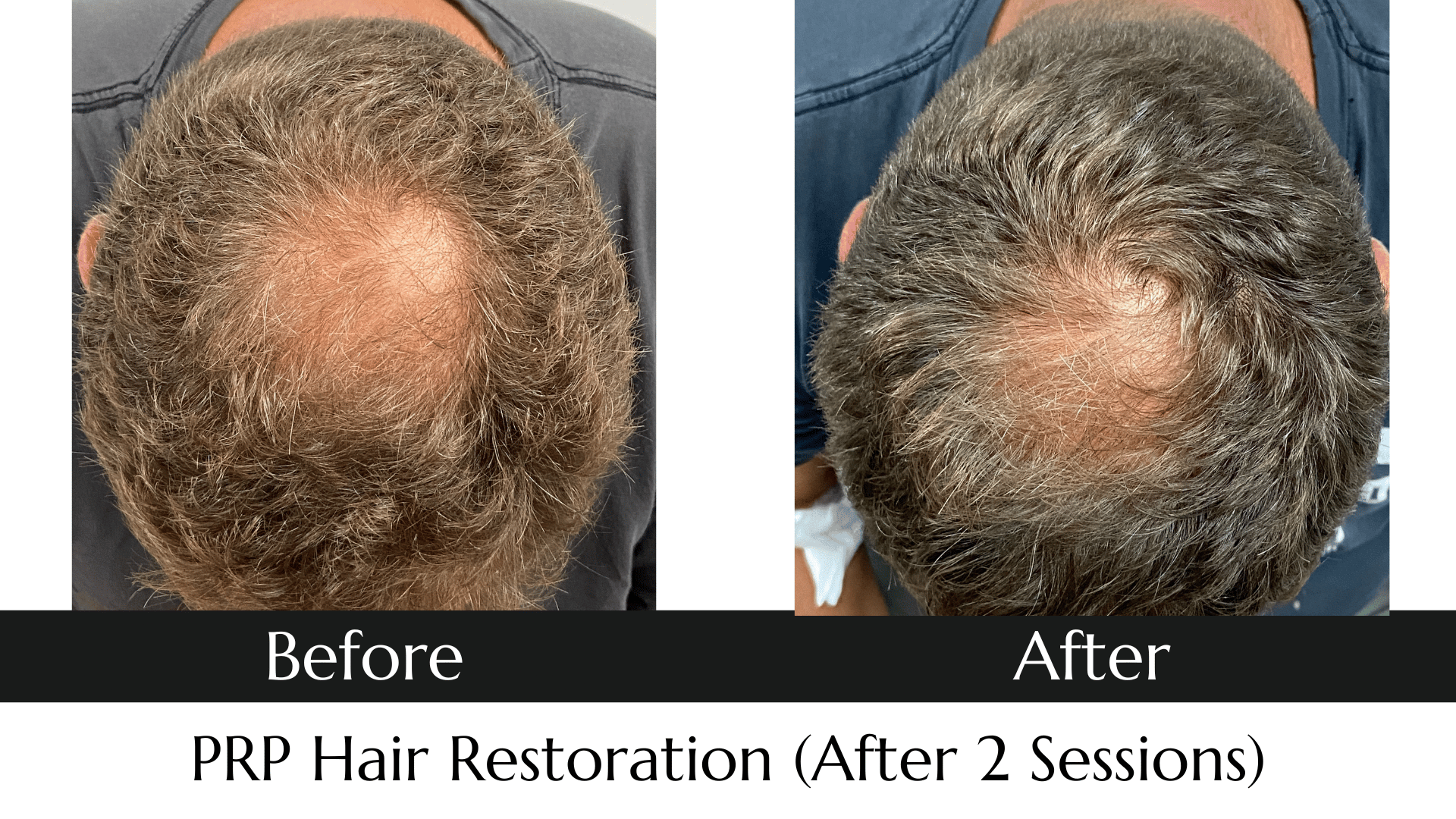 PRP Hair Restoration