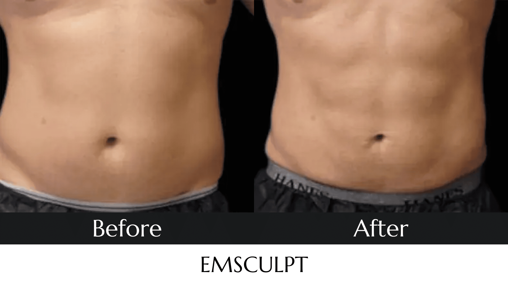 Emsculpt