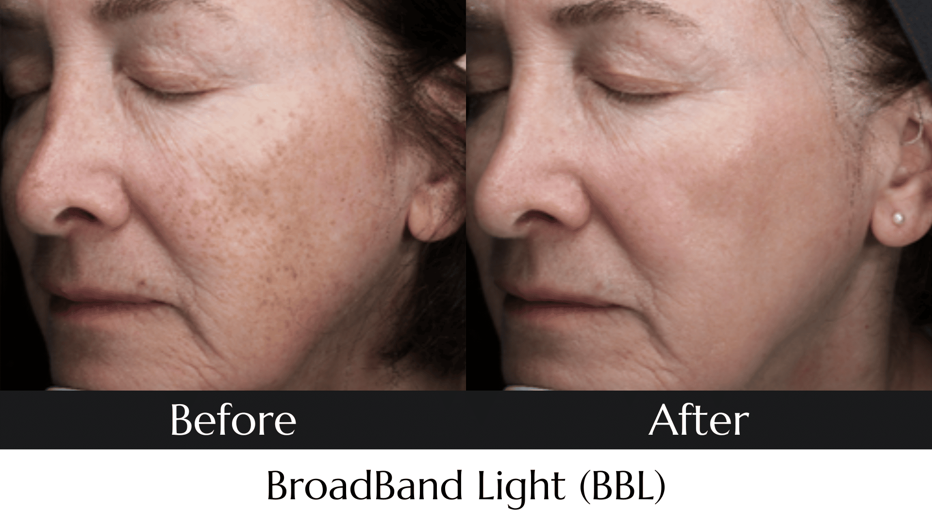 Laser Pigment Removal