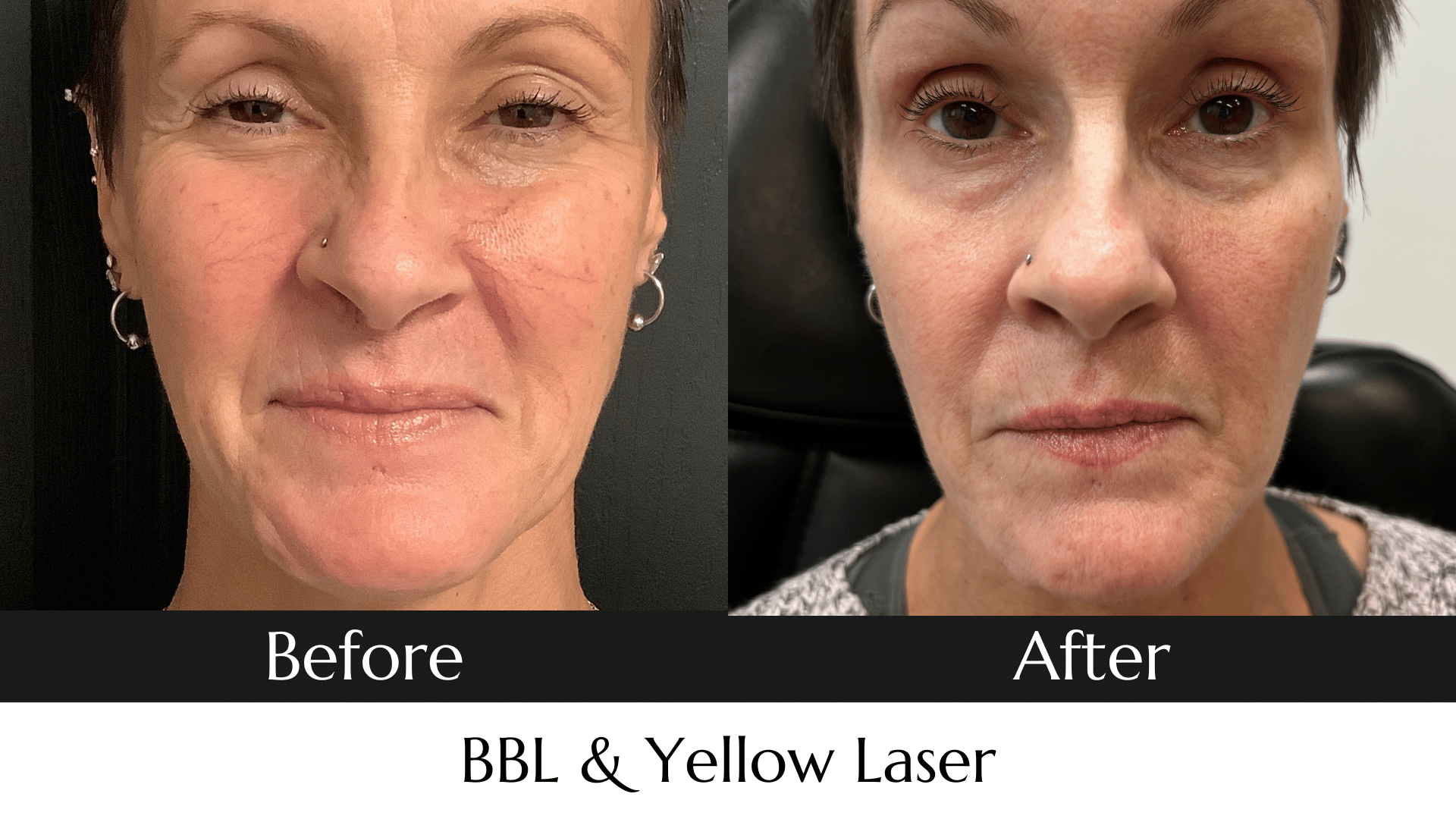 Laser Pigment Removal