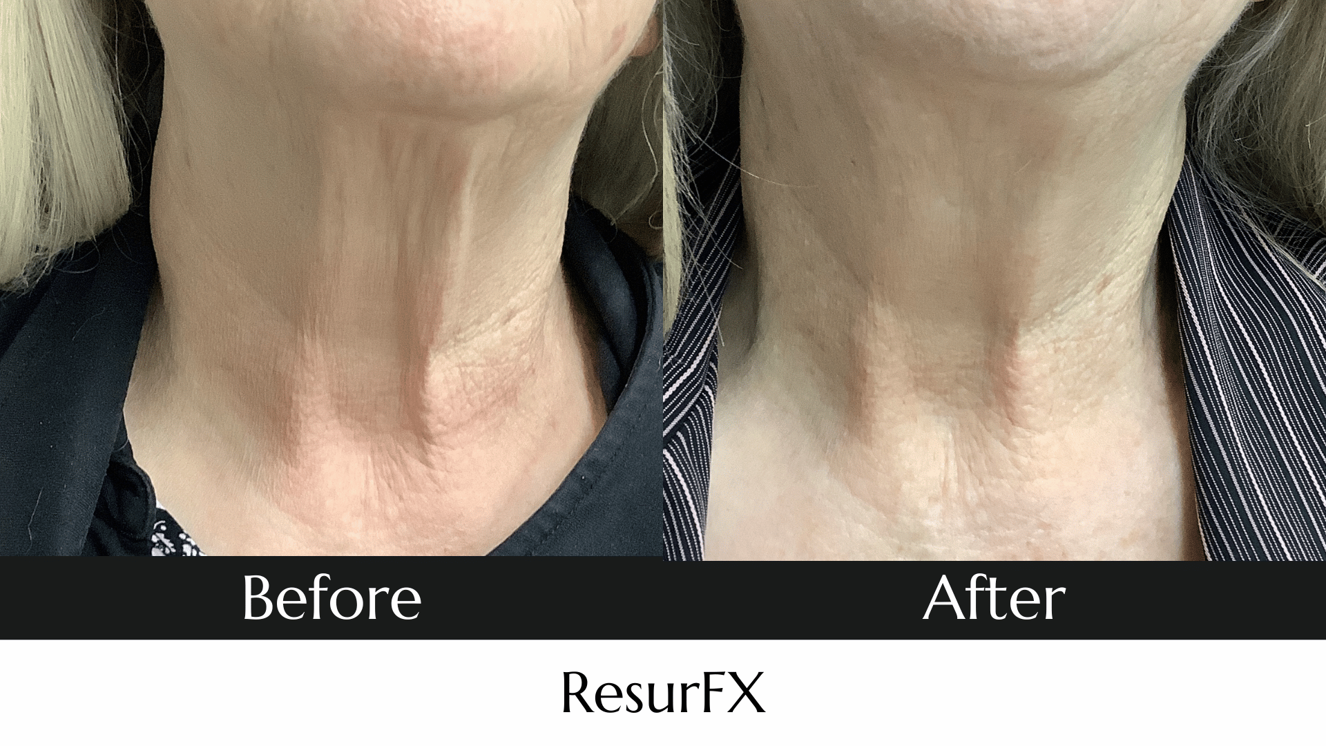 Laser Skin Tightening