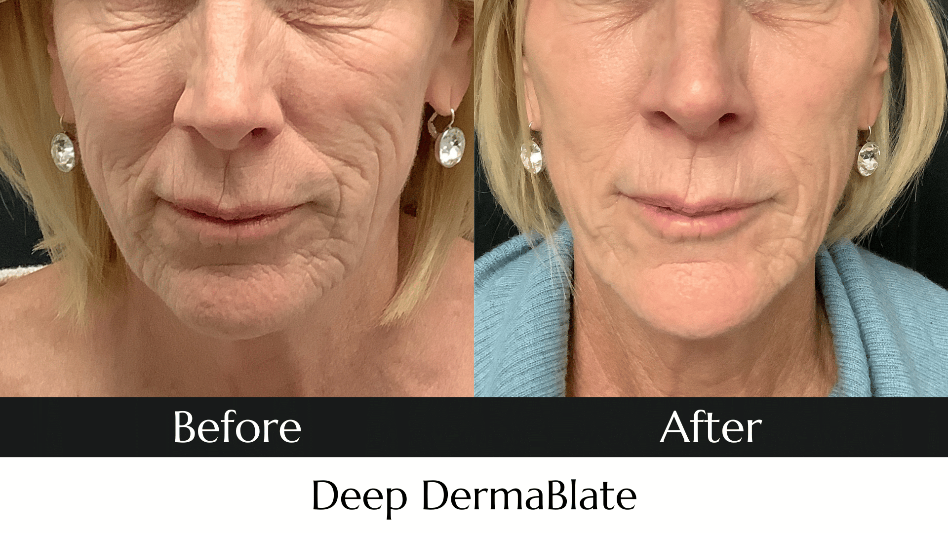 Laser Skin Resurfacing