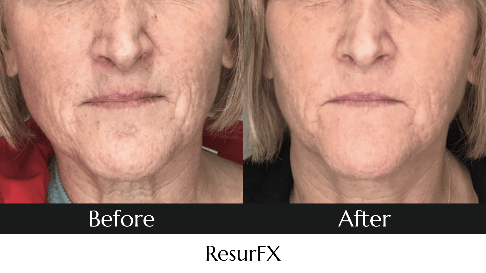 Laser Skin Resurfacing